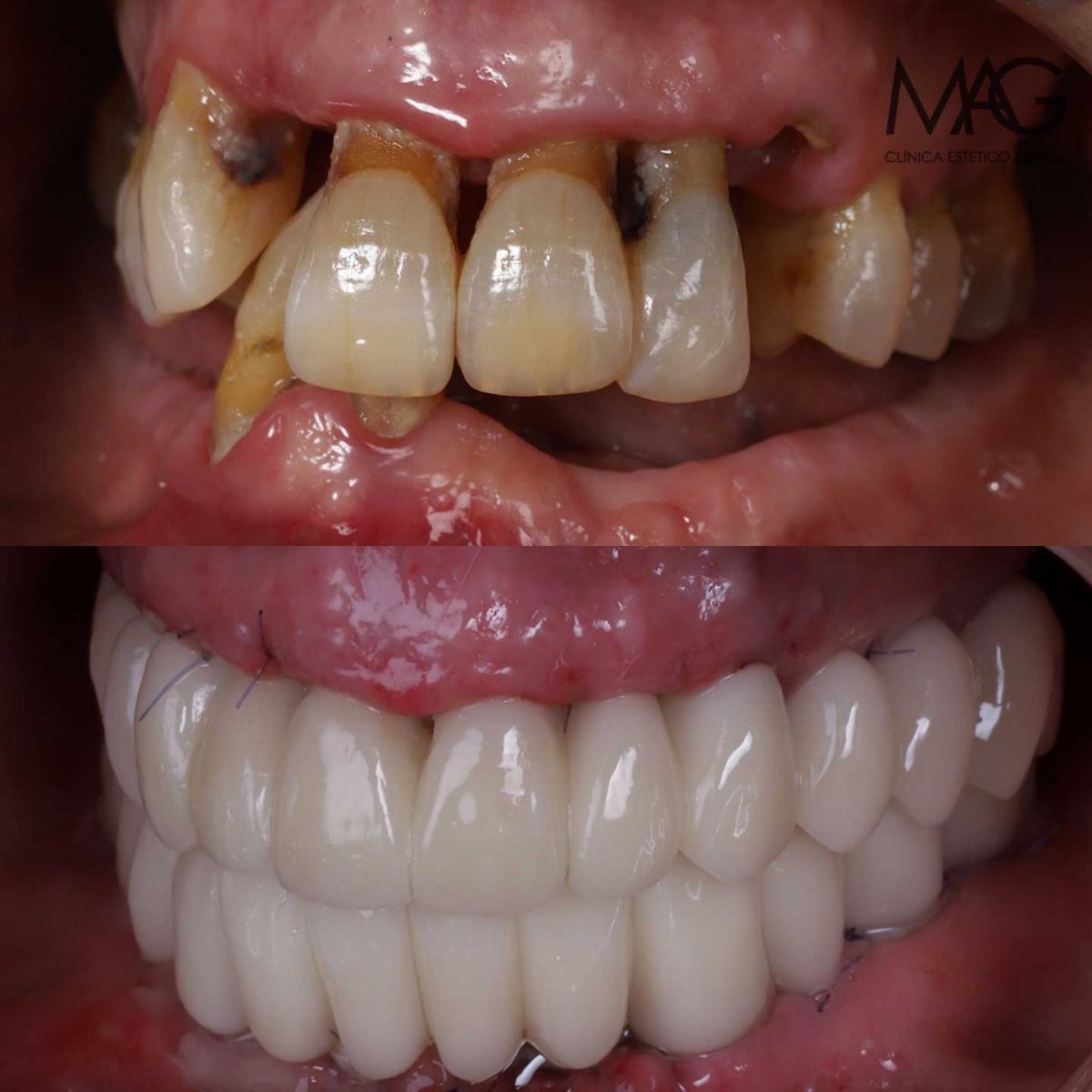 Solución a enfermedad periodontal avanzada, piorrea.