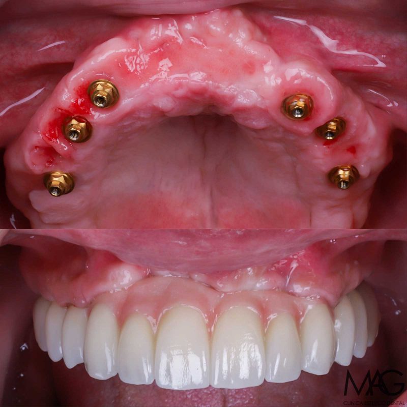 Solution to edentulism with dental implants - Clinical case