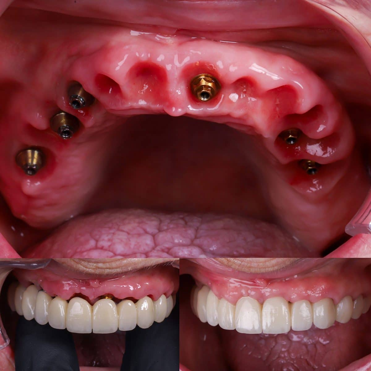 Implantes para toda la boca ¿Qué debo saber? - MAG Dental