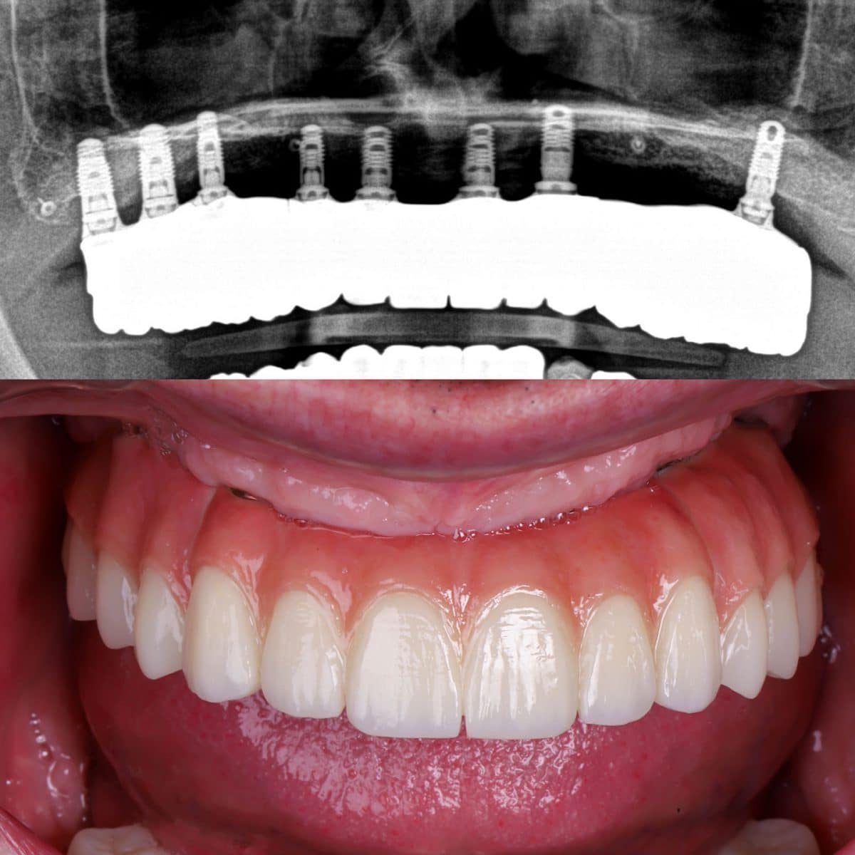 Implantes para toda la boca ¿Qué debo saber? - MAG Dental