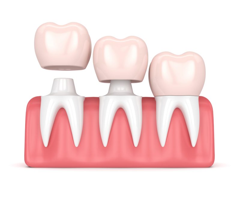 Dental implants without screws
