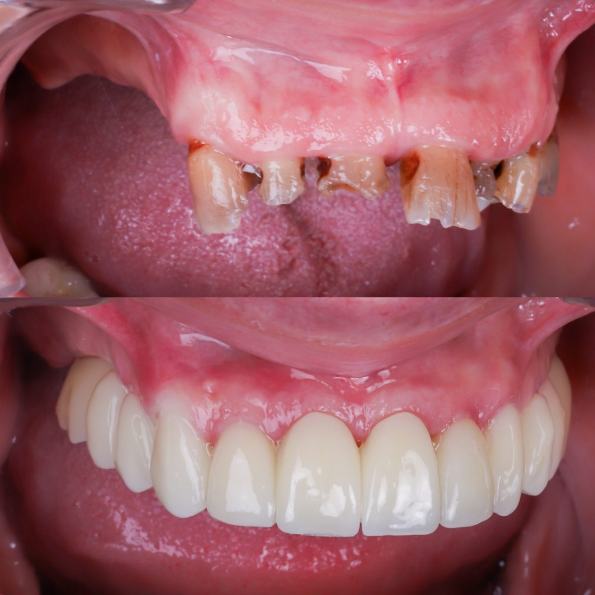 Las 10 mejores marcas de implantes dentales - Ranking