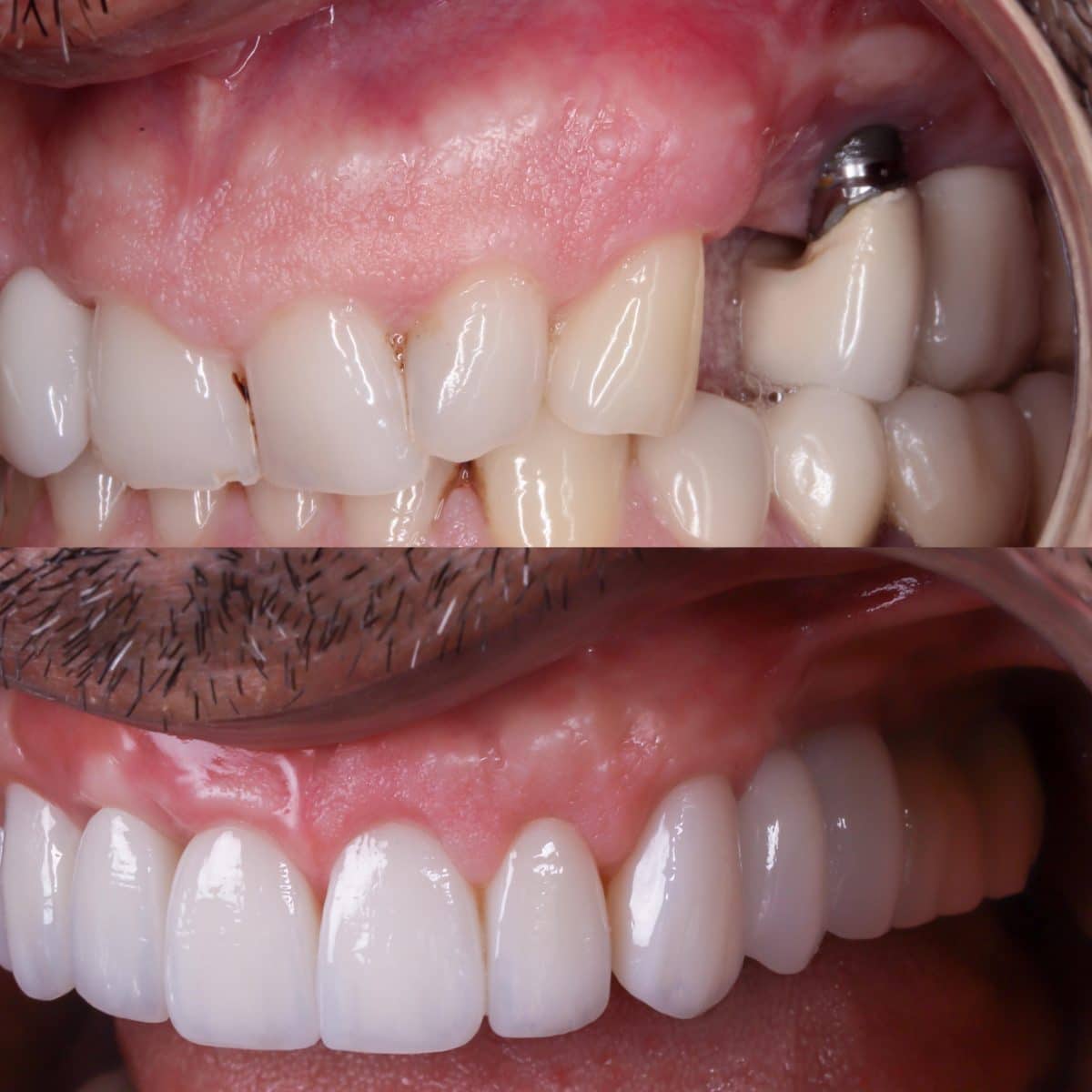 Dental implant rejection: symptoms, causes and solutions